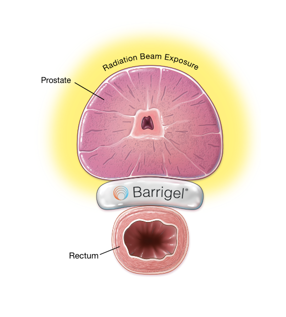 Barrigel Spacer | Minimize Prostate Radiation Side Effects